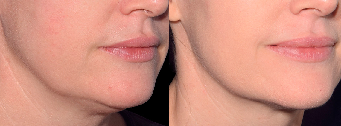 EMFACE - naturalne podniesienie owalu twarzy